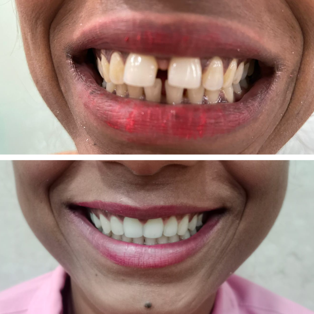 Smile Pro Aligner