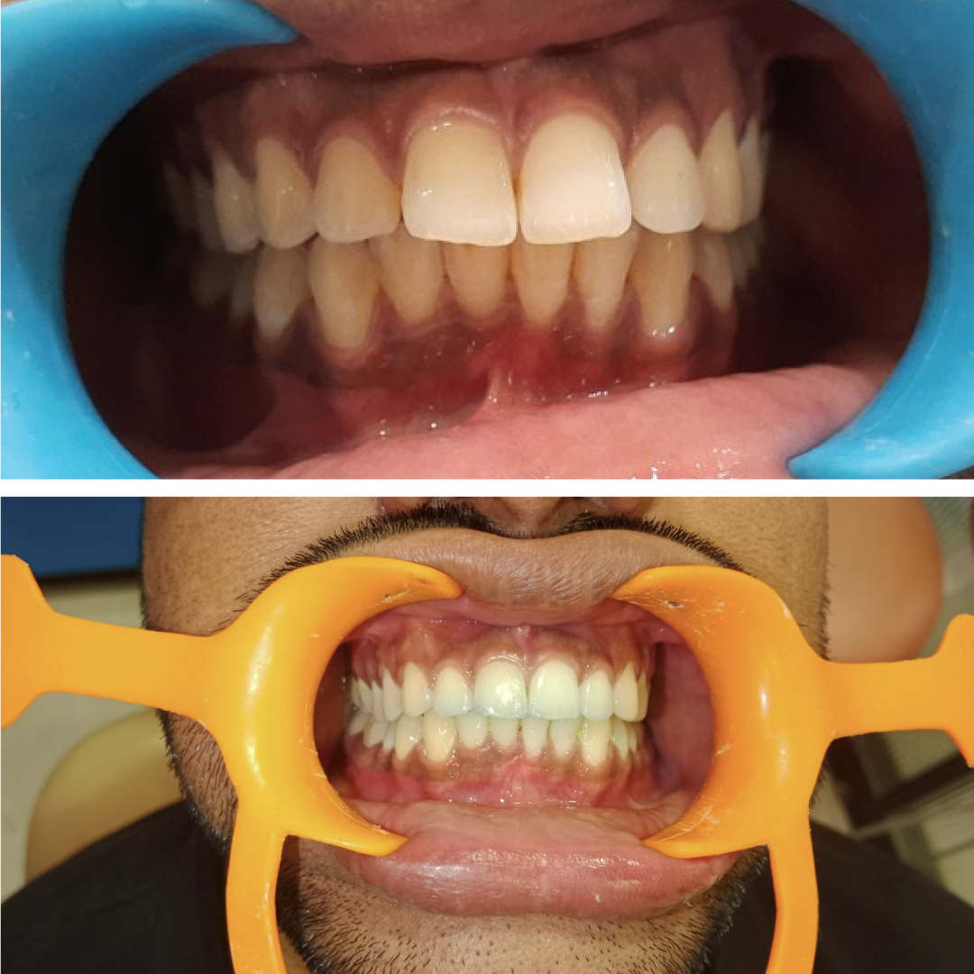 Smile Pro Aligner